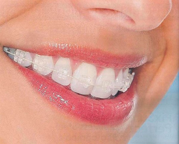 Ortodoncia de Brackets